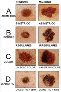 Lunares cancerígenos: ¿Cómo detectarlos? - Periódico La Patria